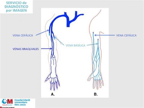 Sistema Venoso Miembro Superior