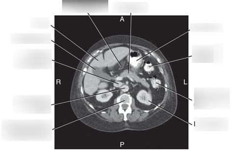 Ct Abdomen Diagram Quizlet
