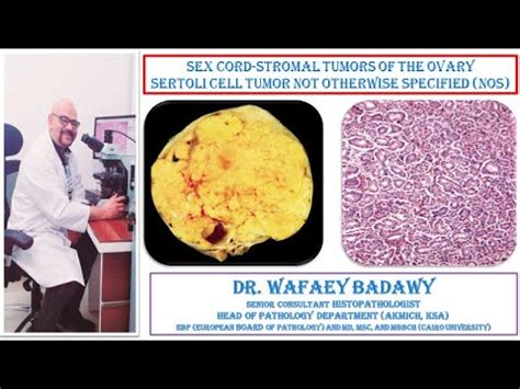 Sex Cord Stromal Tumors Of The Ovary Sertoli Cell Tumor Nos By Dr
