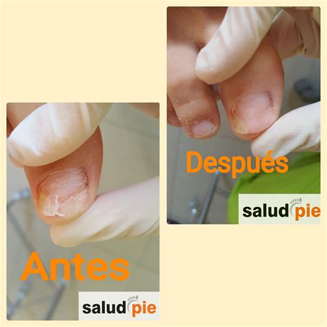 Reconstrucción ungueal Salud Pie Centros de Podología en Murcia y