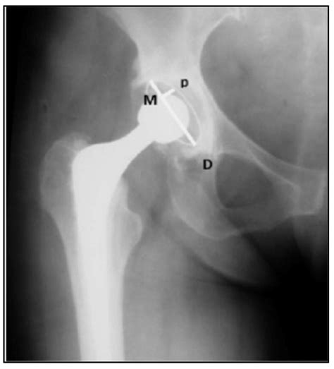 JCM Free Full Text Effect Of Total Hip Arthroplasty With Ceramic