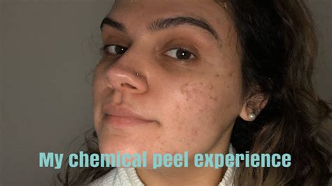 My Chemical Peel Experience The Good And The Bad Youtube