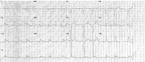 Sgarbossa Criteria Litfl Ecg Library Diagnosis