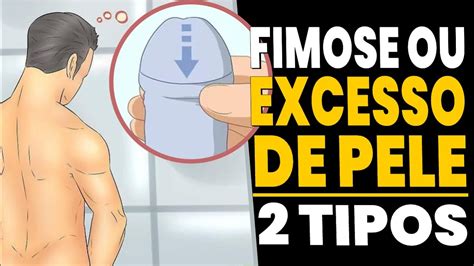 2 Formas de saber se você tem FIMOSE ou EXCESSO DO PELE NA CABEÇA DO