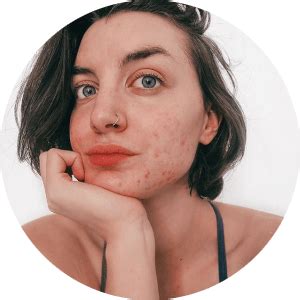 Blizny po trądziku domowe sposoby na zredukowanie DERM pl