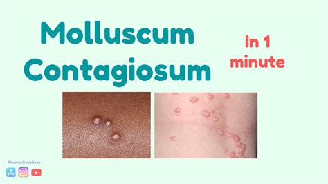 Molluscum Contagiosum Causes Symptoms And Treatment Youtube