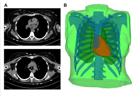 figure 1 from evaluation of fifteen algorithms for the resolution of the electrocardiography