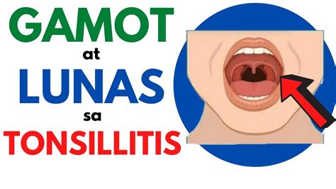 LUNAS At GAMOT Sa TONSILLITIS Masakit LUMUNOK Namamagang TONSILS Sa