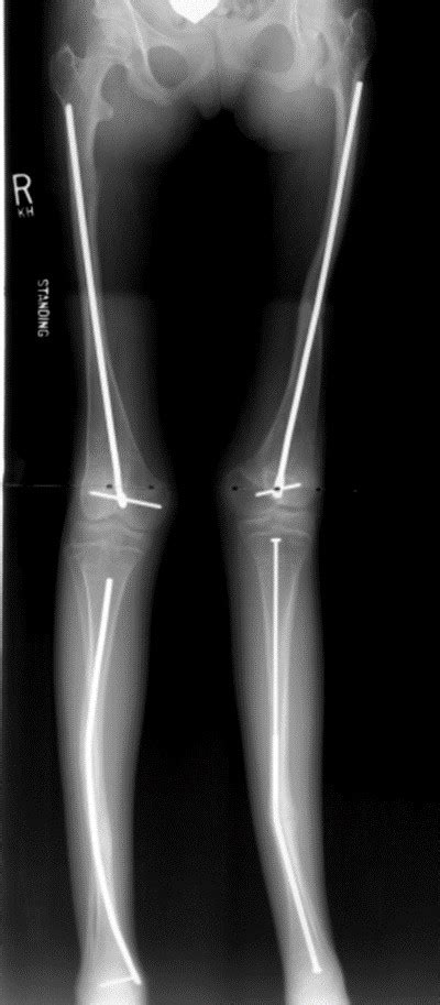 Osteogenesis Imperfecta Treatment