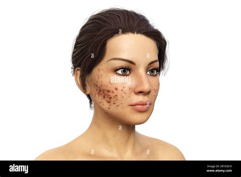 Acne Vulgaris On A Teenage Girl S Face Computer Illustration Acne Is