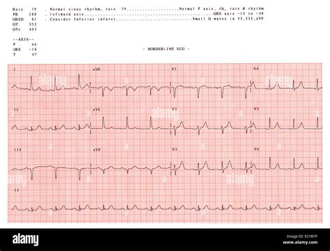 Electrocardiogram Normal Sinus Rhythm