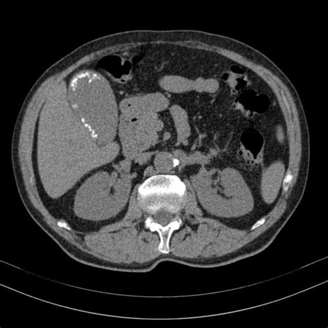 Biliary Microlithiasis Radiology Case Radiopaedia Org Radiology