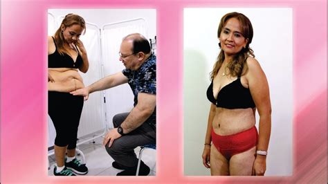 LIPOABDOMINOPLASTIA CIRUGÍA PARA REDUCIR EL ABDOMEN ANTES Y DESPUÉS
