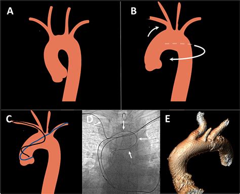 Frontiers Left Vs Right Radial Approach For Coronary Catheterization