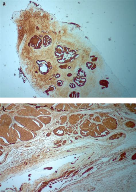A Photomicrograph Showing PSAP Positive Immunostain Control