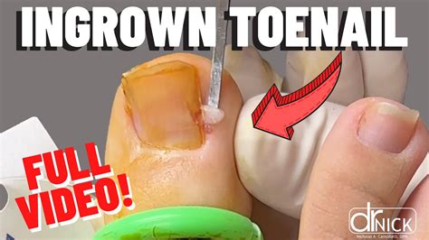 ASMR Ingrown Toenail Surgery Dr Nick Campitelli YouTube