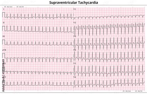 ECG Supraventricular Tachycardia SVT 12 Lead ECG Common Case 6