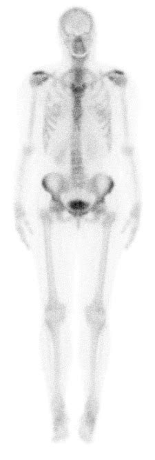 Figure Normal Appearance Of Technetium 99m MDP Bone Scan Contributed