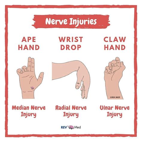 Doctor Medicine On Instagram Median Nerve Ape Hand