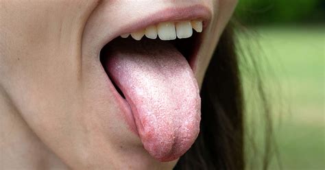 Saburra lingual cómo limpiar la lengua blanca Gastaminza