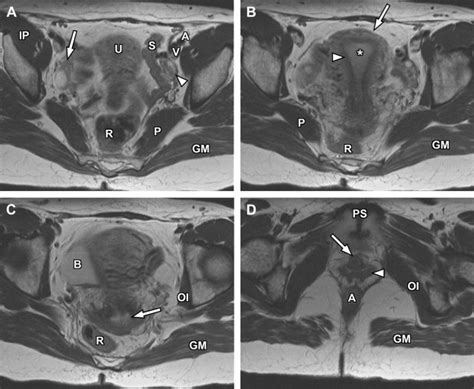 Pelvis Muscles Mri Anatomy Normal And Variant Pelvic Anatomy On Mri