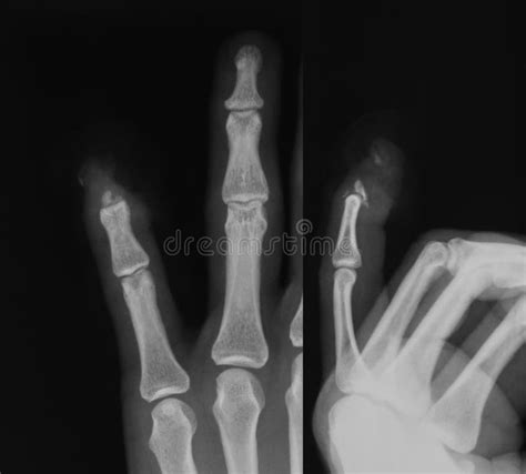 Imagen De La Radiografía De La Fractura Del Dedo Meñique Foto de