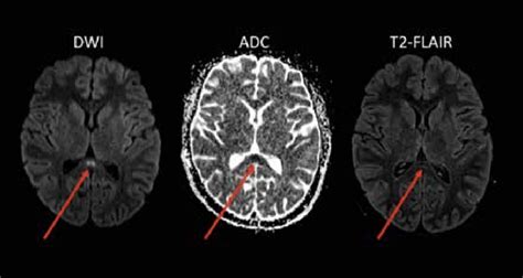 Diffusion Weighted Images Dwi And Adc Maps Show A Single Area Of