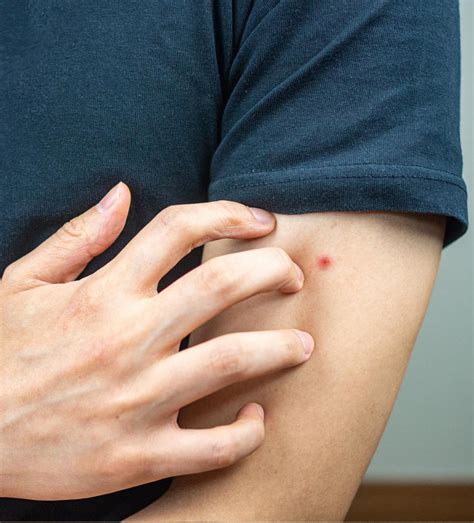 Piqûres de moustiques comment les reconnaître et les soulager