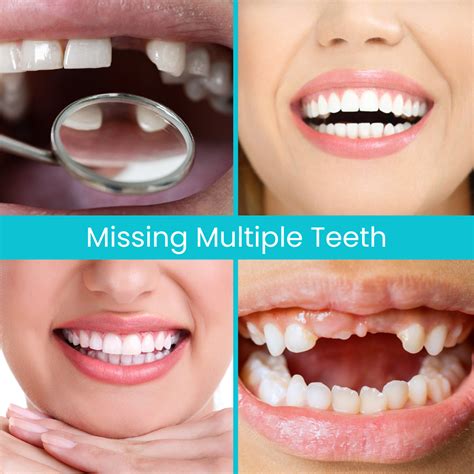 Missing Multiple Teeth