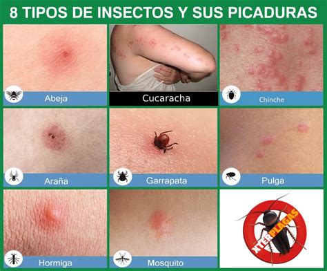 Como Reconocer Las Picaduras De Diferentes Tipos De Insectos Y Que