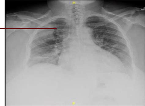 Opacity Chest X Ray
