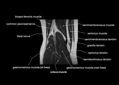Knee Anatomy MRI Knee Coronal Anatomy Free Cross Sectional Anatomy