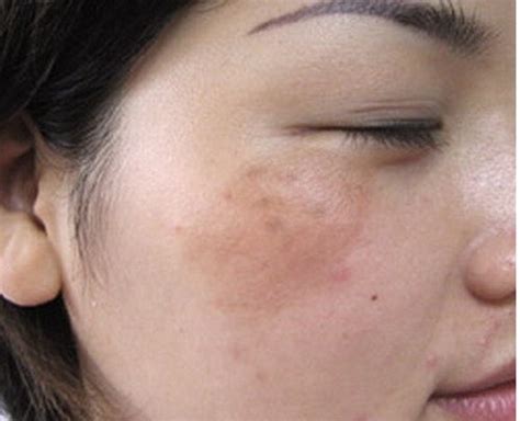 Hình Ảnh Nám Chân Sâu Tại Nhà Cực Đơn Giản Mà Hiệu Quả Nám Chân Sâu