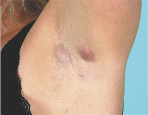 Stage 1 Hidradenitis Suppurativa