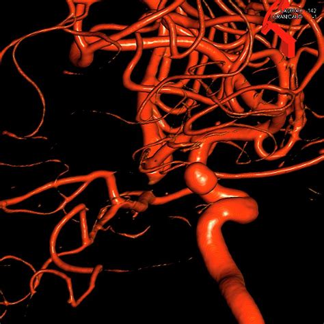 Brain Aneurysm 1 Photograph By Zephyr Science Photo Library Pixels