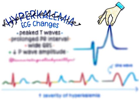 Hypokalemia Hyperkalemia Ekg Changes Etsy