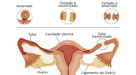 GRAVIDEZ APÓS UMA LAQUEADURA TUBÁRIA É POSSÍVEL IPGO