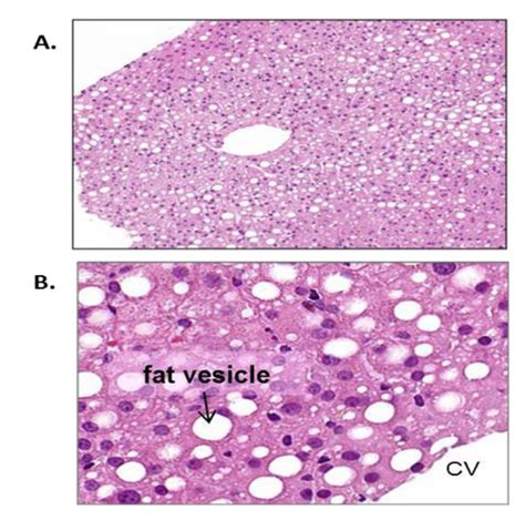Liver Pathology Flashcards Quizlet