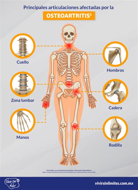 Qué tratamientos existen para la osteoartritis Vivir Sin Límites