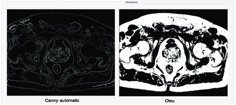example of a prostate mri image using a canny automatic threshold and download scientific