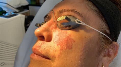 SEE A PORT WINE STAIN BIRTHMARK OF 40 YEARS IMPROVE WITH VBEAM VASCULAR