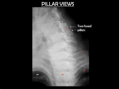 Cervical Spine Diagram Hot Sex Picture