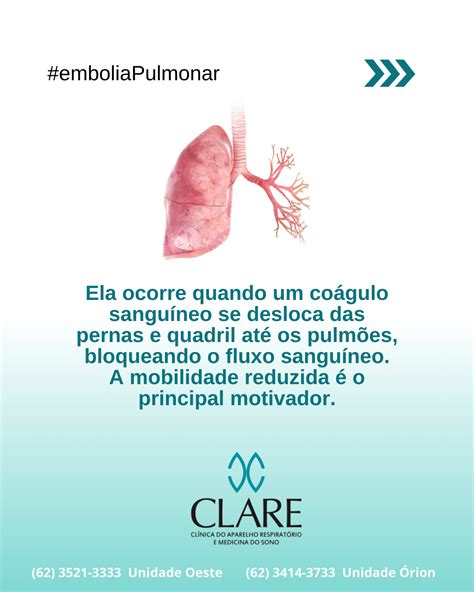 O que é embolia pulmonar Veja causas sintomas e tratamentos Clínica