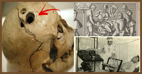 9 Most Horrifying Ancient Medical Treatments Which Fortunately Are Not