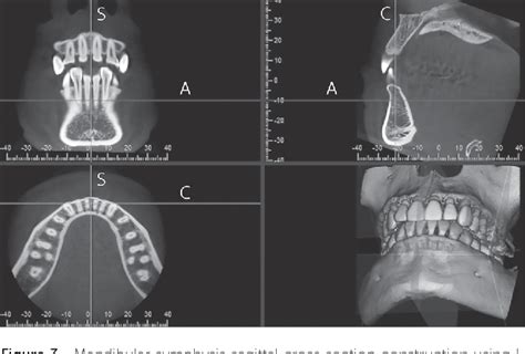 Figure 3 From Relationship Between Mandibular Symphysis Dimensions And