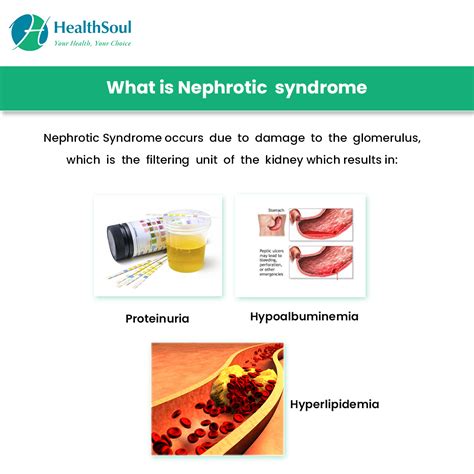 รายการ 92 ภาพ Nephrotic Syndrome พยาธ สภาพ ความละเอยด 2k 4k