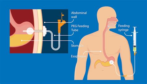 Feeding Tubes — What You Should Know Roswell Park Comprehensive Cancer Center Buffalo Ny