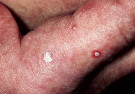 Superficial Basal Cell Carcinoma Nose
