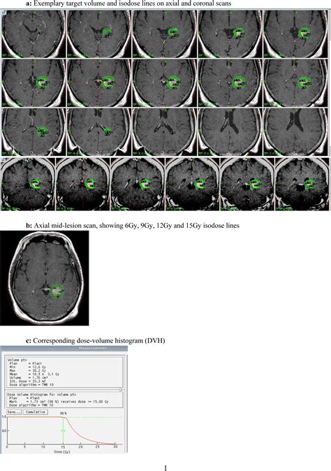 Efficacy And Safety Of Primary Stereotactic Radiosurgery In Patients
