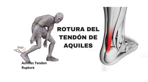 Lesion Del Tendon De Aquiles